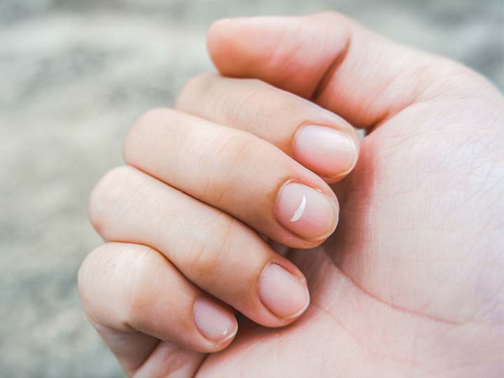 Why Is There a White Spot on My Nail? Common Causes